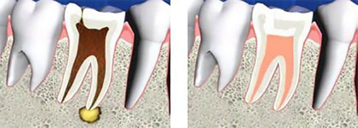 Endodontics - Clínica Dental Padrós