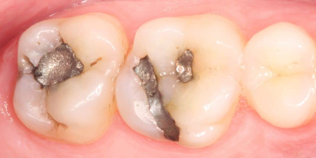 Eliminación amalgamas - Clínica Dental Padrós